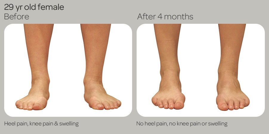Foot Posture Centre: Natural Corrective Podiatry Success Stories
