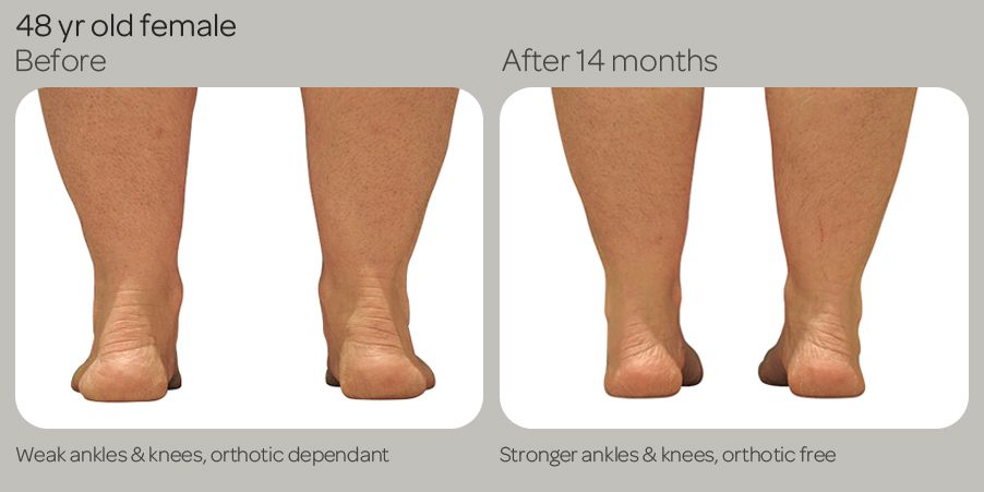 Foot Posture Centre: Natural Corrective Podiatry Success Stories