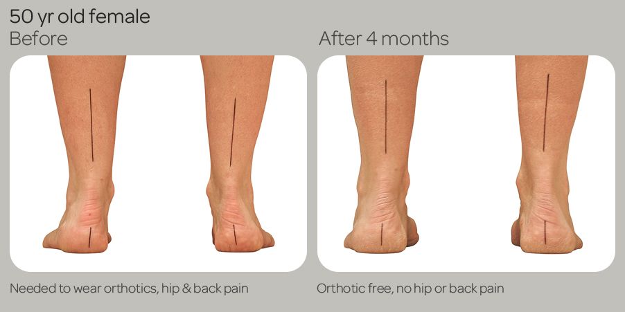 Foot Posture Centre: Natural Corrective Podiatry Success Stories