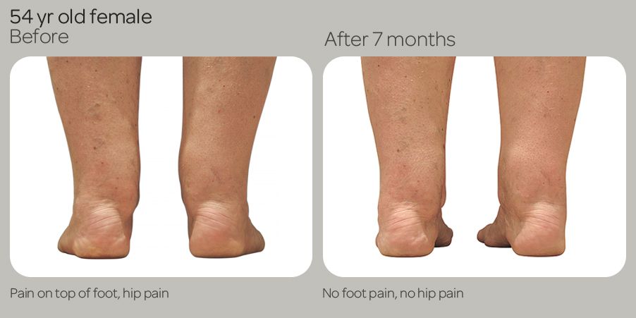 Foot Posture Centre: Natural Corrective Podiatry Success Stories